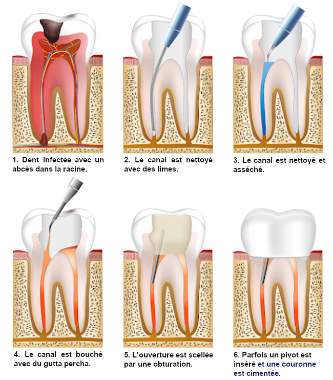 Endodontie - Centre dentaire Touchette - Gatineau